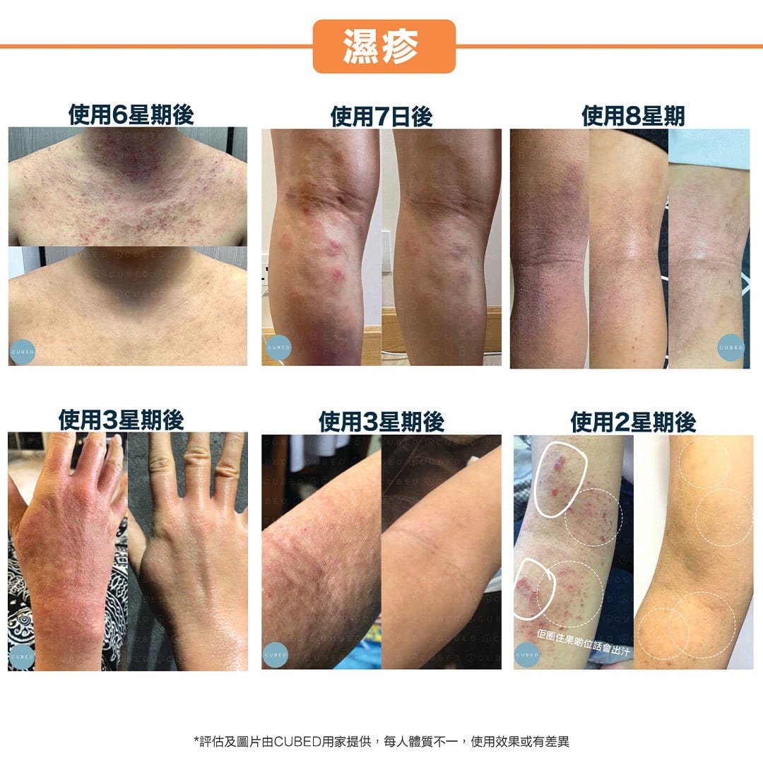 Cubed Ultra Moisturizing Set - Relieves eczema inflammation, swelling, redness and weeping ...