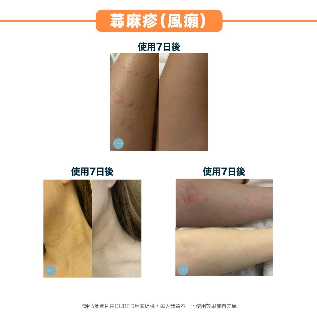 Cubed Body Butter - Immediate relieves itchy eczema, redness and inflammation | Recommended for ...