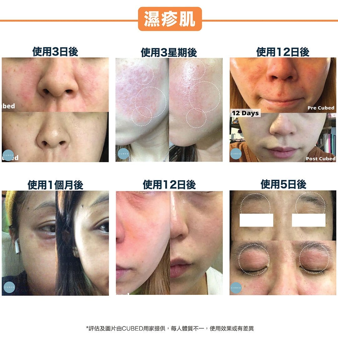 Cubed Magic Cream - Instant relieves facial eczema, itchy skin, redness and inflammation and ...